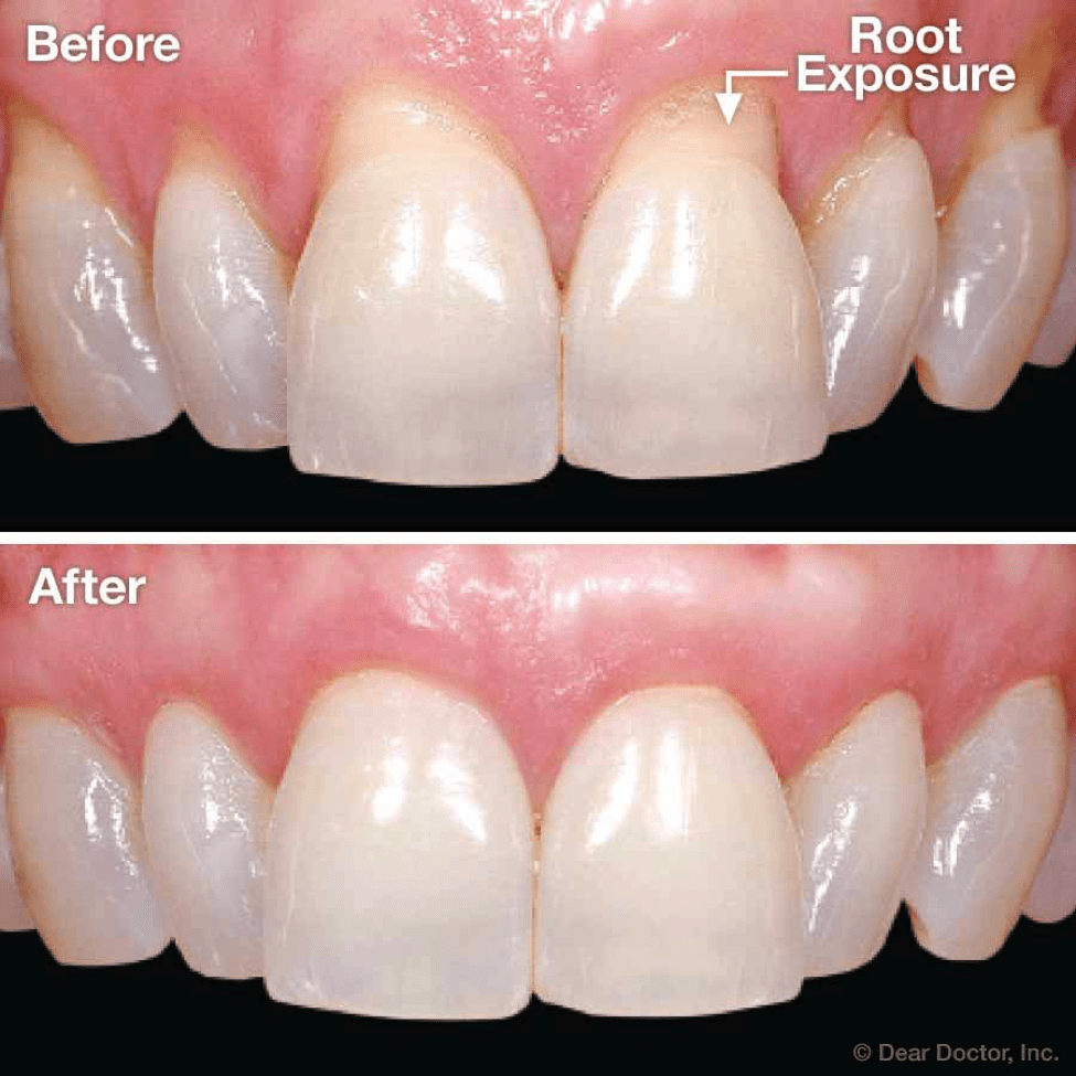 Gum Recontouring » La Jolla, CA - La Jolla Dentistry - Dr. D'Angelo, Dr ...
